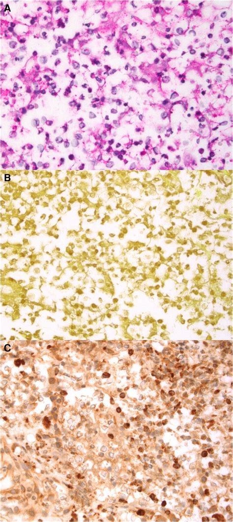 Sweet Syndrome Imitating Cutaneous Cryptococcal Disease Pmc