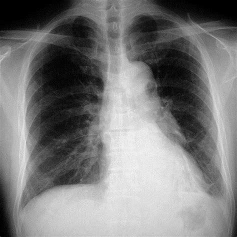 Abnormal Chest X Ray Images