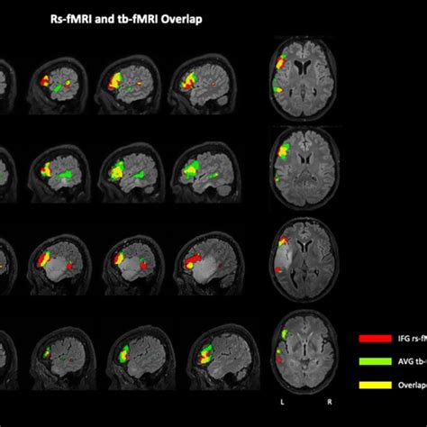 Task Based Fmri And Rs Fmri Overlap Analysis Pipeline Download