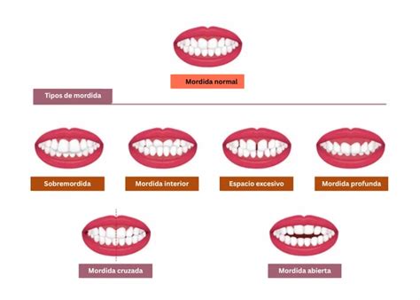 Tipos De Mordida Dental ¿cómo Es La Mordida Perfecta