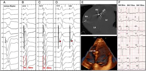 Pacing Electrocardiogram Characteristics And The Location Of The Pacing Download Scientific