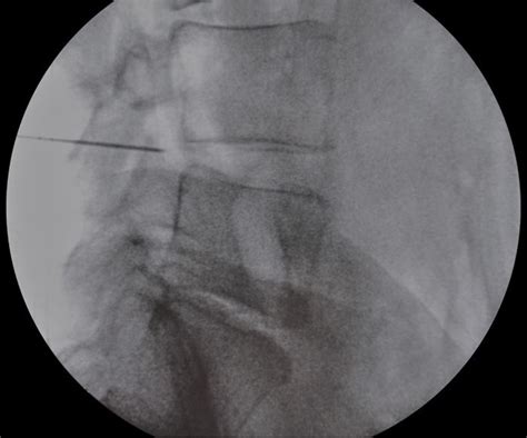 Percutaneous Disc Decompressions Anesthesia Key