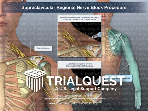 Supraclavicular Regional Nerve Block Procedure