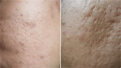 Acne Marks Vs Acne Scars Spot The Key Differences Copenhagen Fashion