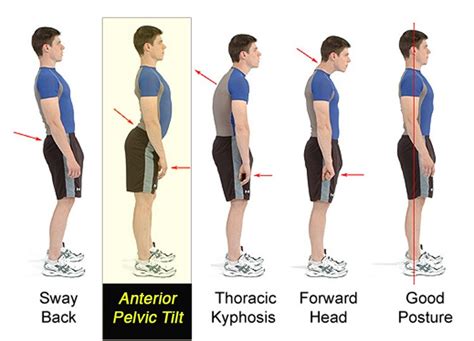 Pelvic Tilt 理学療法 ペルビックティルト Niikzm