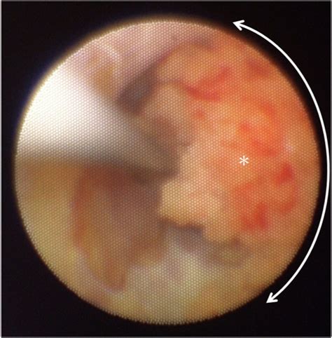 Progression From Nodular Calcification To Calcified Nodules Leading To