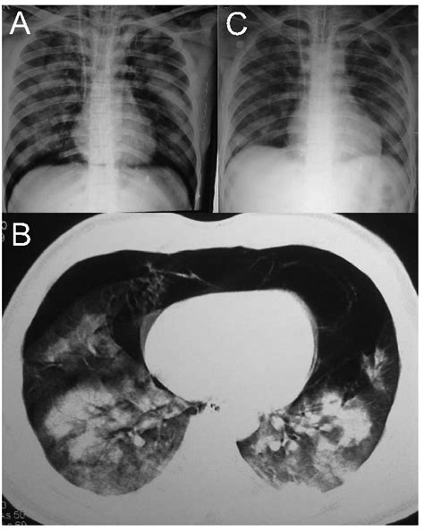 Pneumomediastinum And Bilateral Pneumothorax Following Near Drowning In