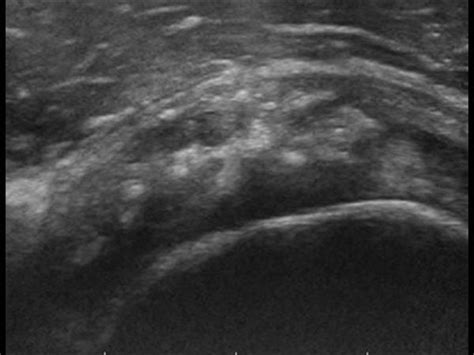 Musculoskeletal Joints And Tendons 6 1 Shoulder Case 6 1 18 Bursa Calcific Bursitis
