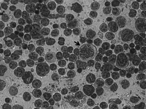 Cytological Finding Of Fna Of The Right Subiliac Lymph Node Stained
