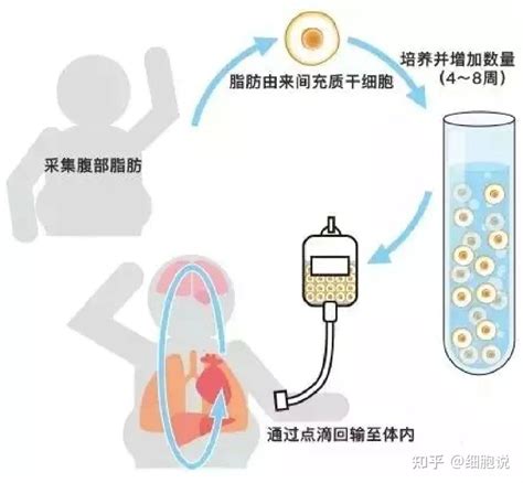 哪些人适合干细胞回输？ 知乎