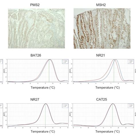 Representative Results Of Crc Case Showing Dmmr Ihc And Msi H By Pcr