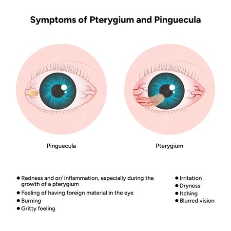 Premium Vector Symptoms Of Pterygium And Pinguecula Optometry Disease