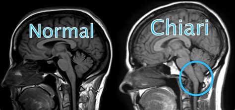 Chiari Surgery Virtual Headache Specialist