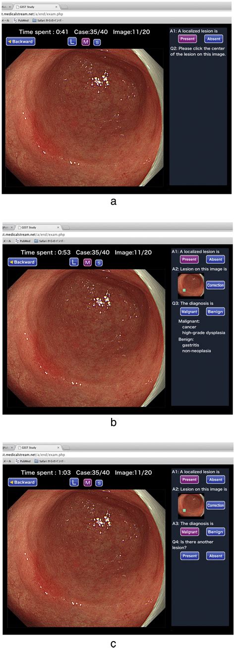 Endoscopic Diagnosis Of Early Gastric Cancer At Juan Harrell Blog