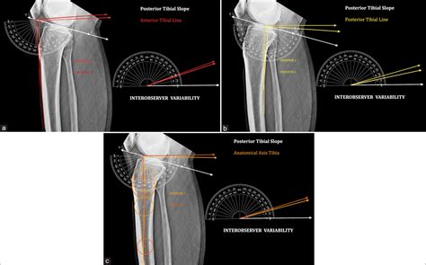 A Novel Precision Technique” For Preoperative Planning Of Posterior