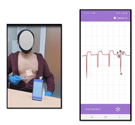 Wearable Dry Electrode Ecg Patch With Optimized Geometry