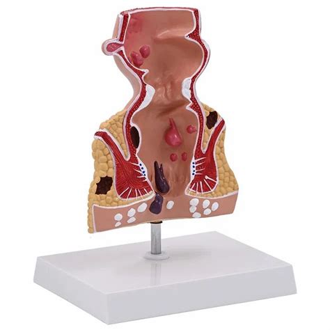 Teaching Model Of Rectal Pathology Model Intestinal Specimen Human