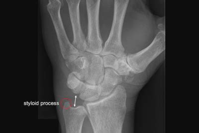 Commonly Missed Or Mismanaged Wrist Injuries Emergency Medicine Cases