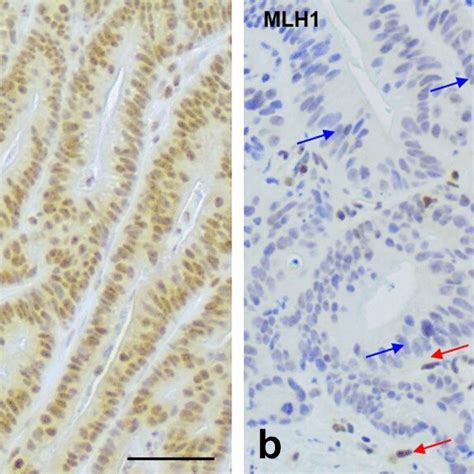 A Biopsy Case From A Mlh1pms2 Mmr Deficient Colorectal Cancer Showing