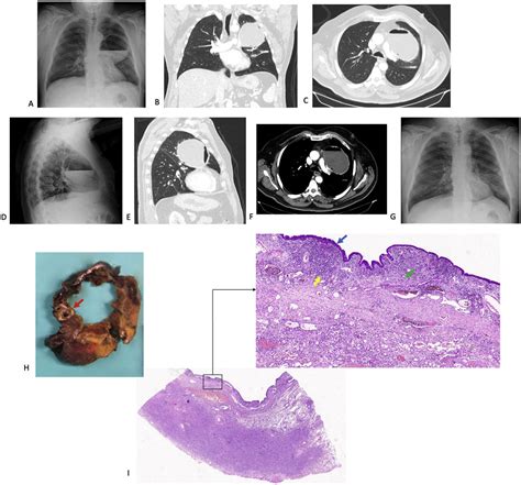 Large Cystic Bronchiectasis A Differential Diagnosis Archivos De