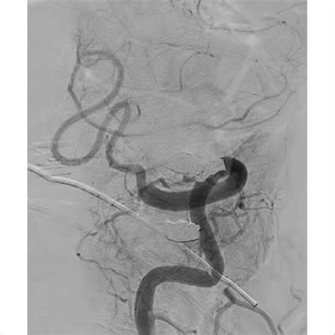 A Repeat Mri Of The Brain Showing Increased Burden Of Diffusion