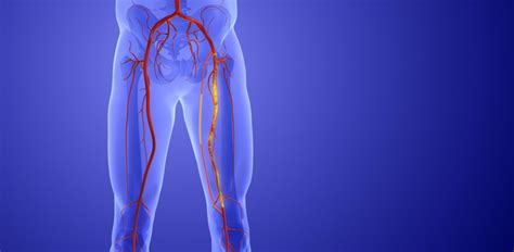 New Study Highlights Sex Differences In Peripheral Vascular Disease