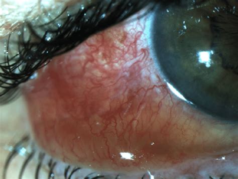 The Patient Presenting With Recurrent Diffuse Scleritis Attacks First Download Scientific