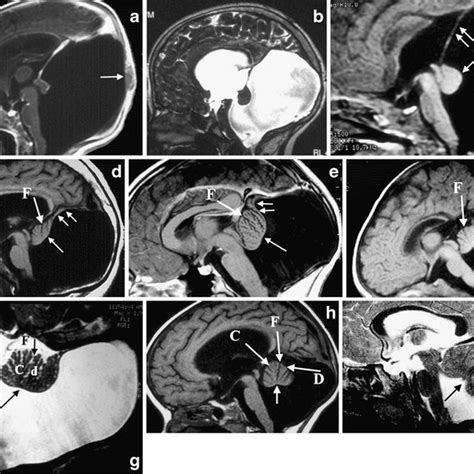 A G Mega Cisterna Magna Or Dandy Walker Malformation Type B Of