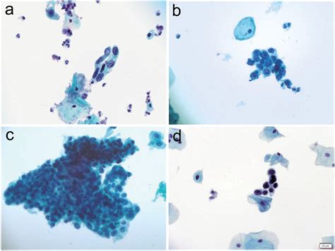 Updates In Cervical Cancer Screening Guidelines The Bethesda System