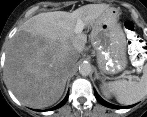Liver Atlas Case 354 Steatosis Steatohepatitis