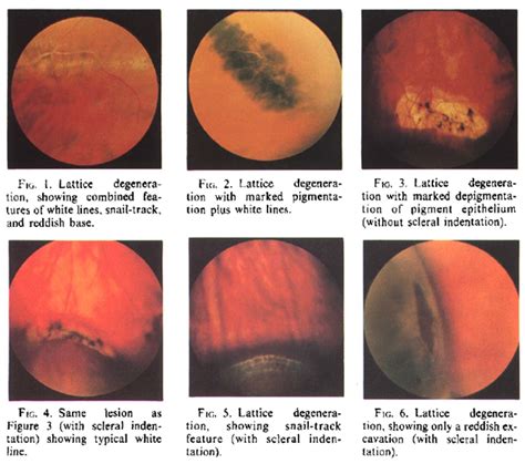 Lattice Degeneration Eyewiki