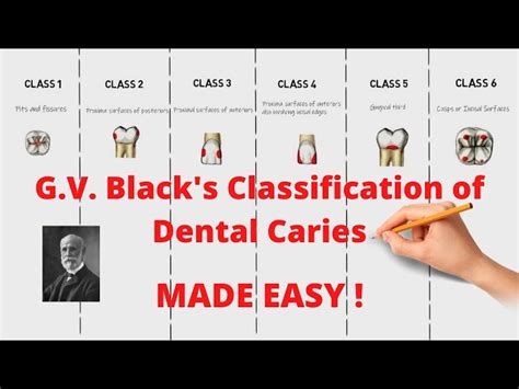Caries Classification