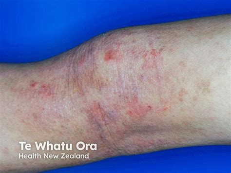 Atopic Dermatitis Images — Dermnet