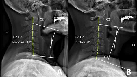 Cervical Spine Alignment Sagittal Alignment Cervical Spine Thkyjc