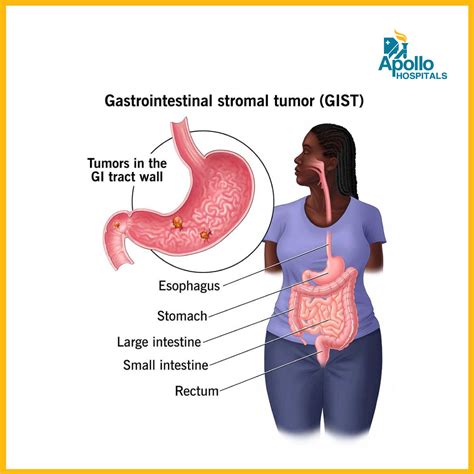 Gastric Stromal Gists Gastrointestinal Stromal Tumour Gmlyp