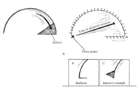 Local Flaps Classifications Pptx
