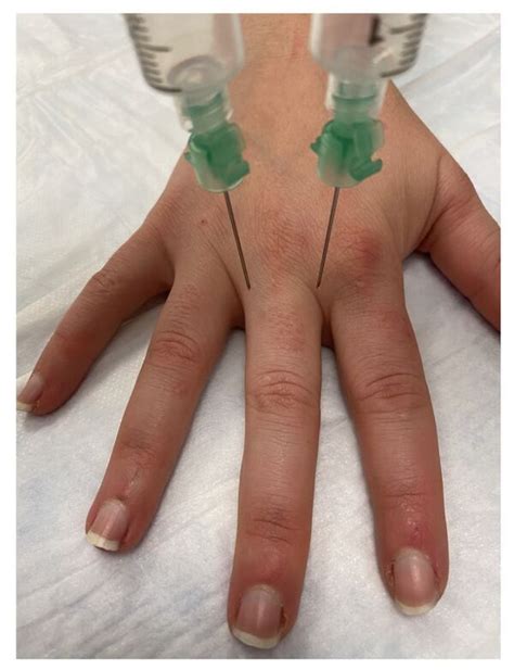 Digital Nerve Block Wikism Sports Medicine Wiki