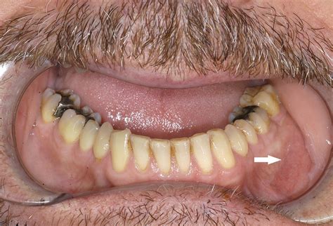 Clinical Intraoral View Showing Slight Swelling In The Premolarmolar