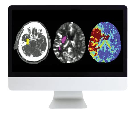 Arrs Code Stroke What Every Radiologist Should Know 2022 Drskool