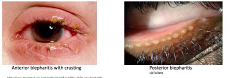 Posterior Blepharitis