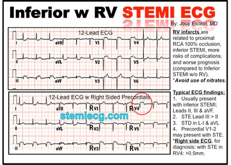 Mastering Stemi Ecg