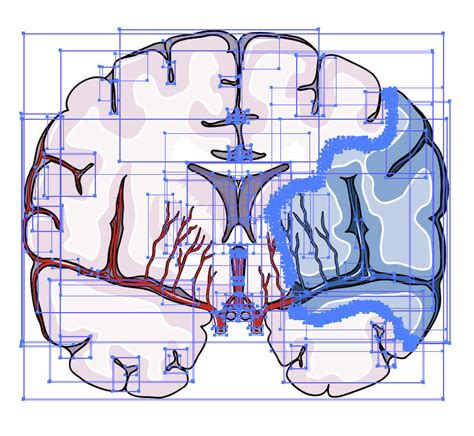 Ischemic Stroke Vector Scientific Illustration