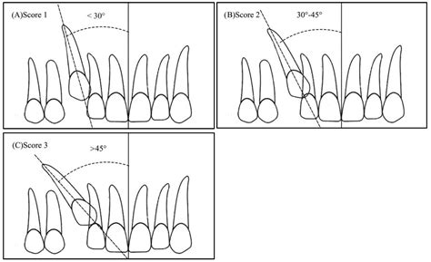 Severity And Treatment Difficulty Of Impacted Maxillary Canine Among