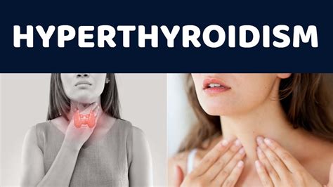 Hyperthyroidism Homeopathic Medicnes For Hyperthyroidism Youtube