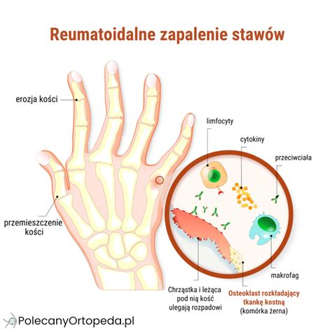 Reumatoidalne zapalenie stawów RZS przyczyny objawy leczenie