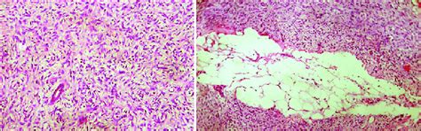 A And B Histopathology Revealing Spindle Shaped Cells In Storiform Download Scientific