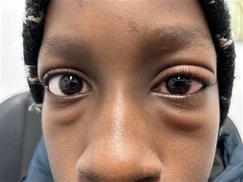 Unilateral Red Eye Itching And Clear Discharge Vernal Conjunctivitis