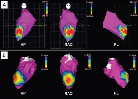 The First Published Example Of Electroanatomic Mapping Style Interface