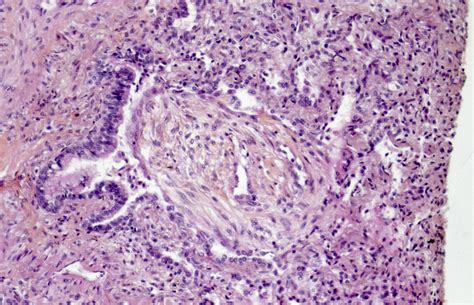 Cryptogenic Organising Pneumonia Stock Image C0618577 Science Photo Library