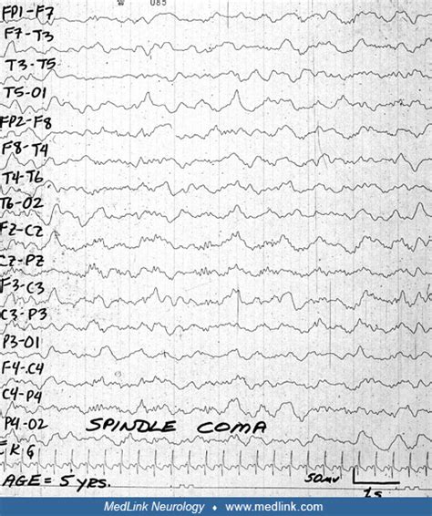 Eeg In Encephalopathic Conditions Medlink Neurology